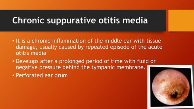 Otitis media ear infection ppt | PPTX | Ear, Nose and Throat Conditions ...