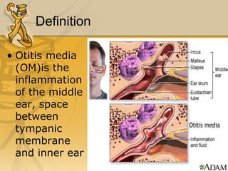 Otitis Media (common) | PPTX