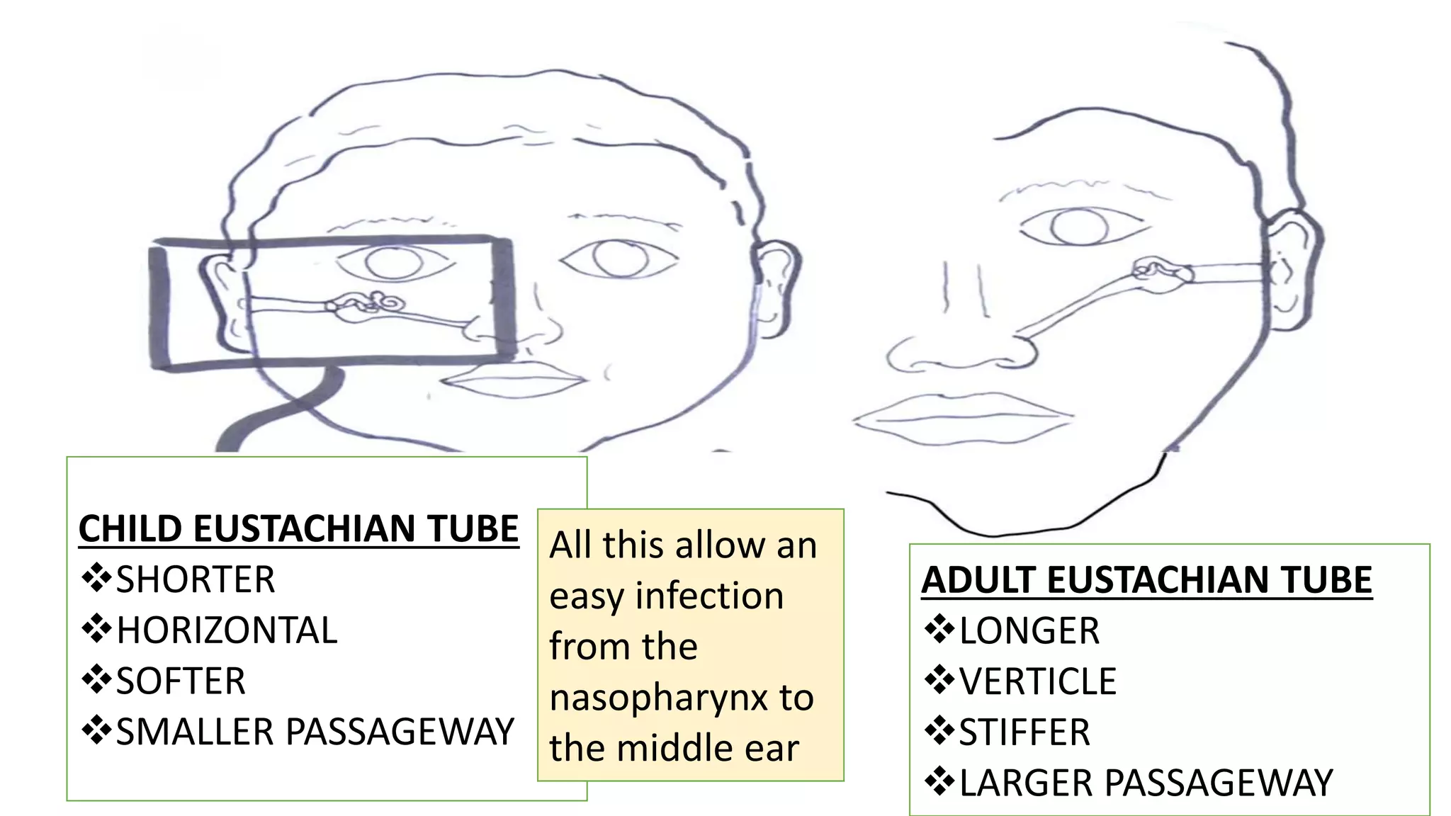 Otitis media | ear infection | PPTX