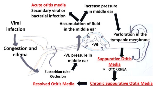 Otitis media | ear infection | PPTX