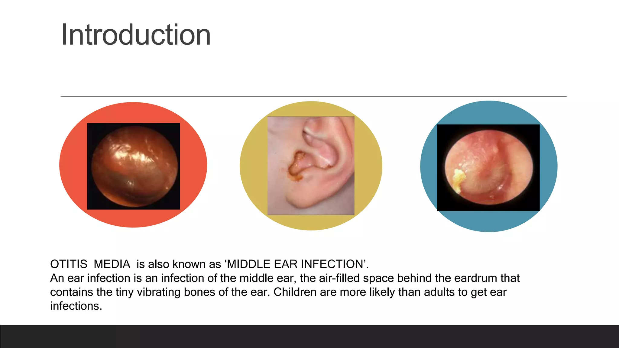 Otitis Media.pptx