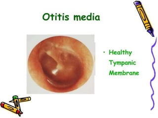 OTITIS MEDIA.pptx