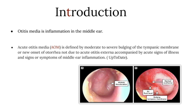 Otitis Media.pdf