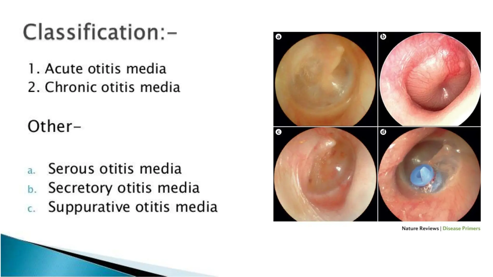 otitis media.pptx