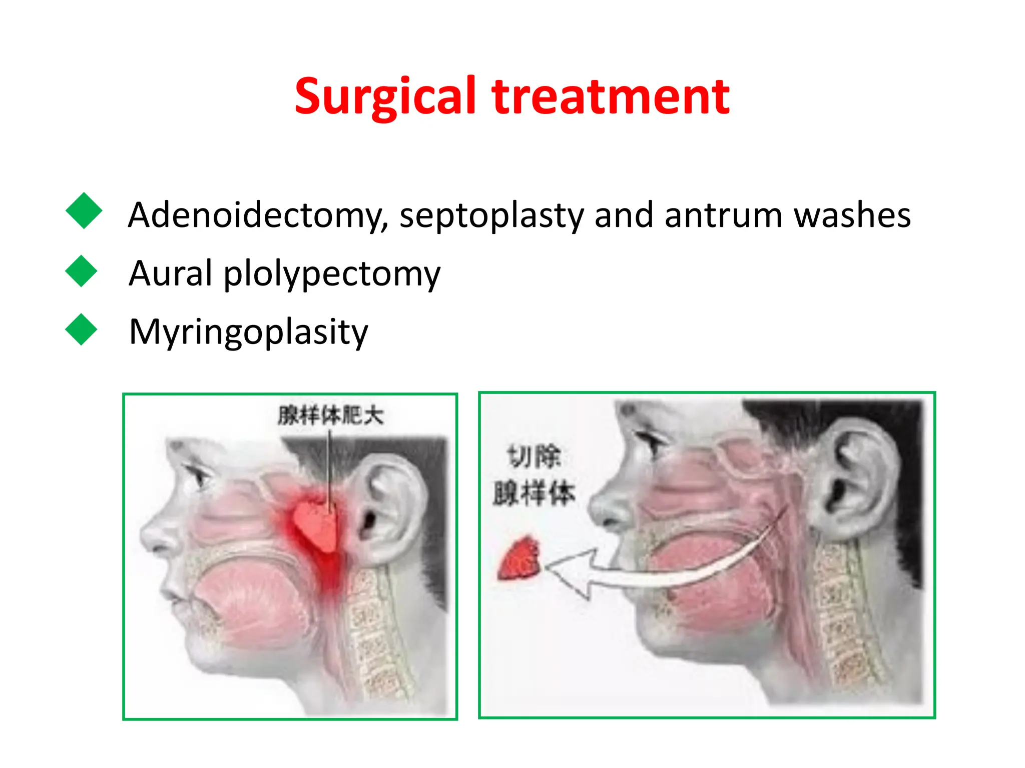 otitis media is the internal infection of ear which causes swelling of ...