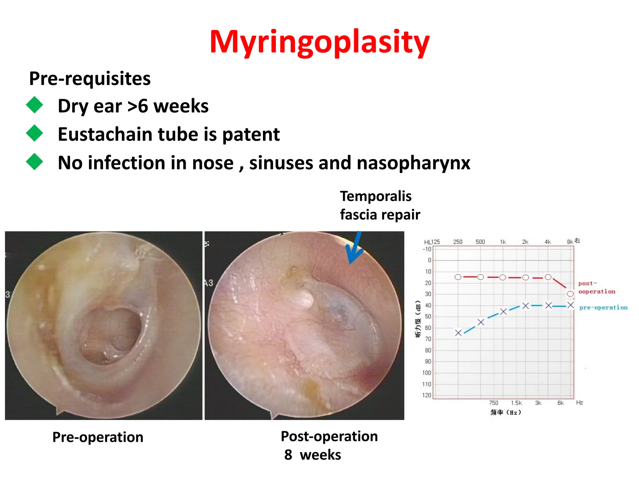 otitis media is the internal infection of ear which causes swelling of ...