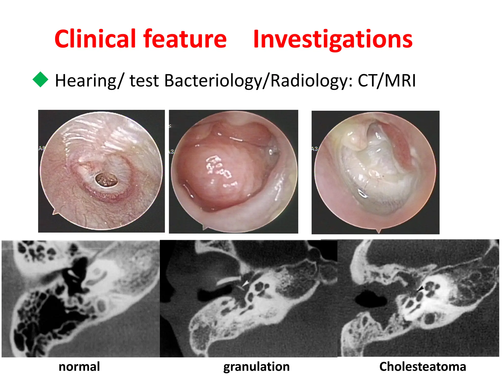 otitis media is the internal infection of ear which causes swelling of ...