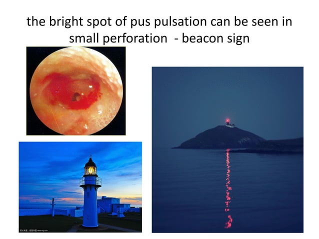 otitis media is the internal infection of ear which causes swelling of ...