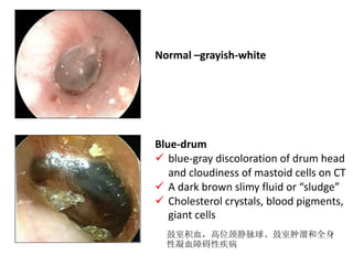 otitis media is the internal infection of ear which causes swelling of ...