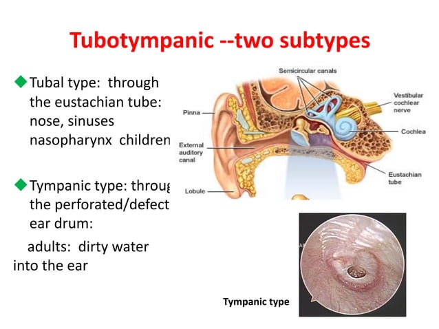 otitis media is the internal infection of ear which causes swelling of ...