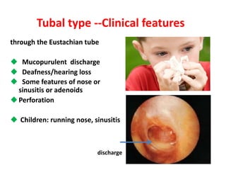 otitis media is the internal infection of ear which causes swelling of ...