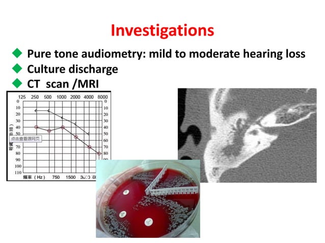 otitis media is the internal infection of ear which causes swelling of ...