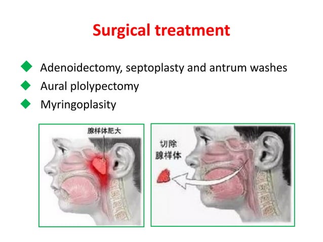 otitis media is the internal infection of ear which causes swelling of ...