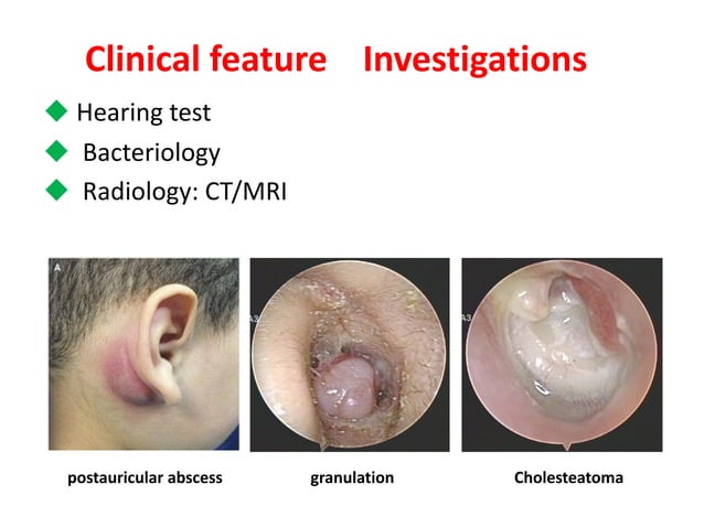 otitis media is the internal infection of ear which causes swelling of mastoid process | PDF ...