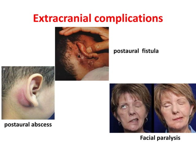 otitis media is the internal infection of ear which causes swelling of ...