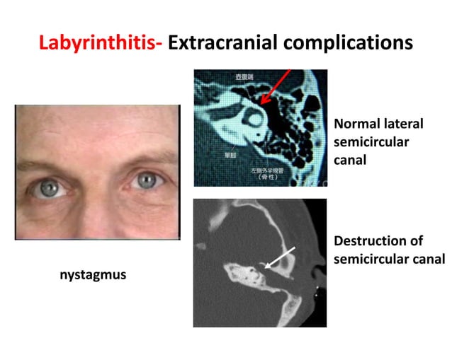 otitis media is the internal infection of ear which causes swelling of ...