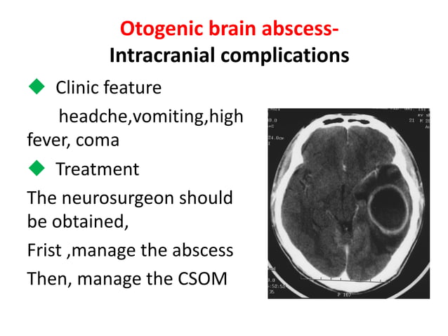 otitis media is the internal infection of ear which causes swelling of ...