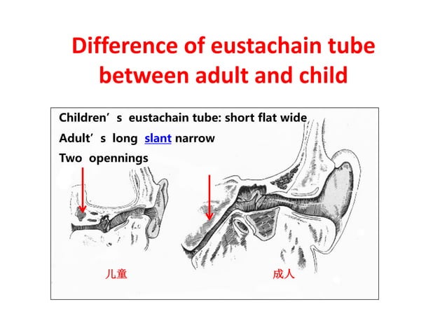 otitis media is the internal infection of ear which causes swelling of ...