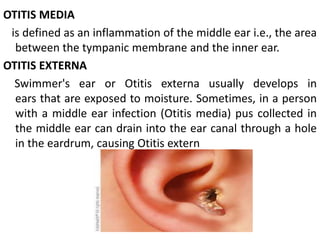 Otitis Media.pptx .. | PPT