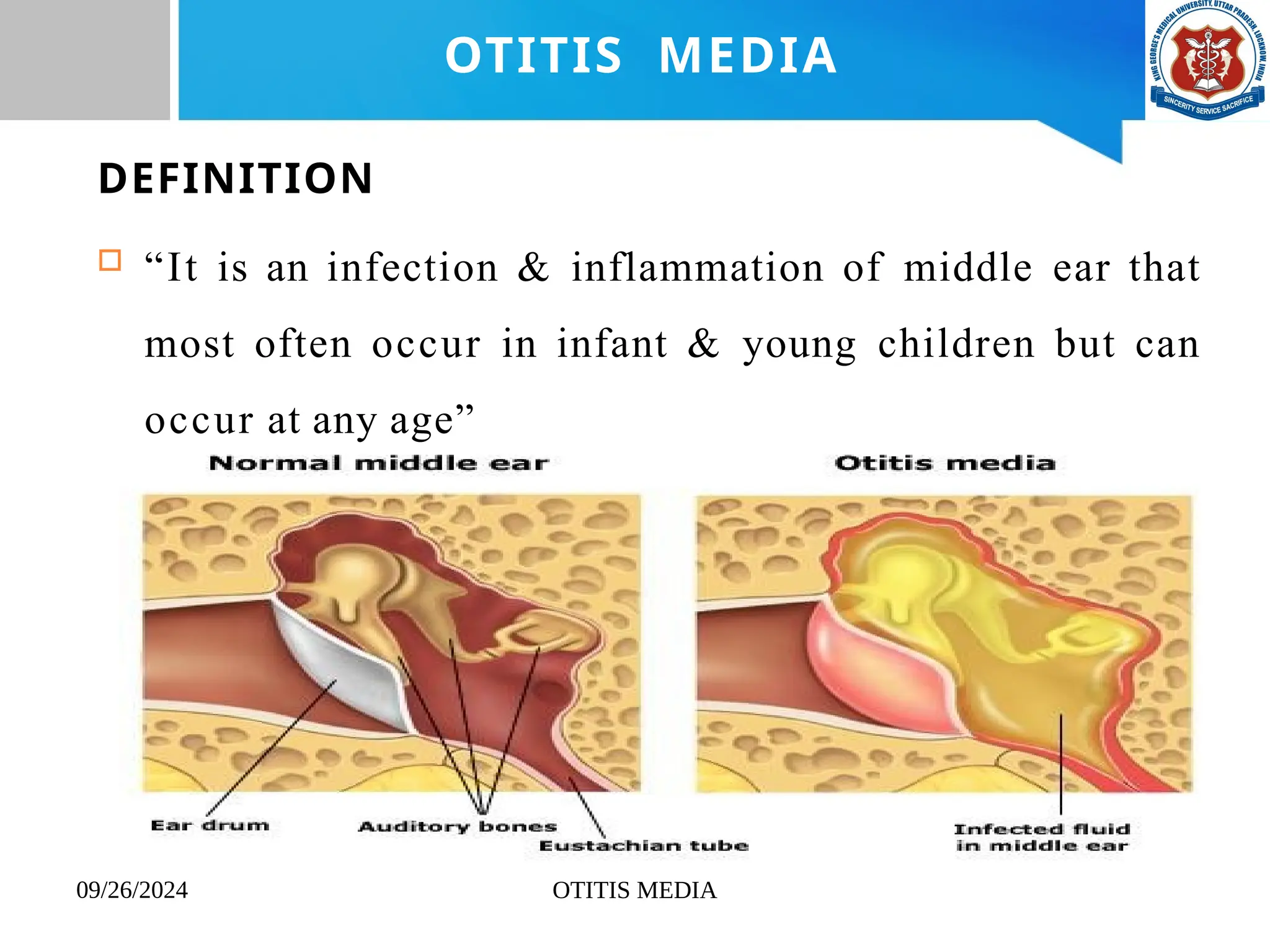 Otitismedia MICROTEACHING FOR MSC NURSING.pptx