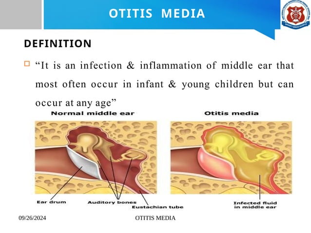 Otitismedia MICROTEACHING FOR MSC NURSING.pptx