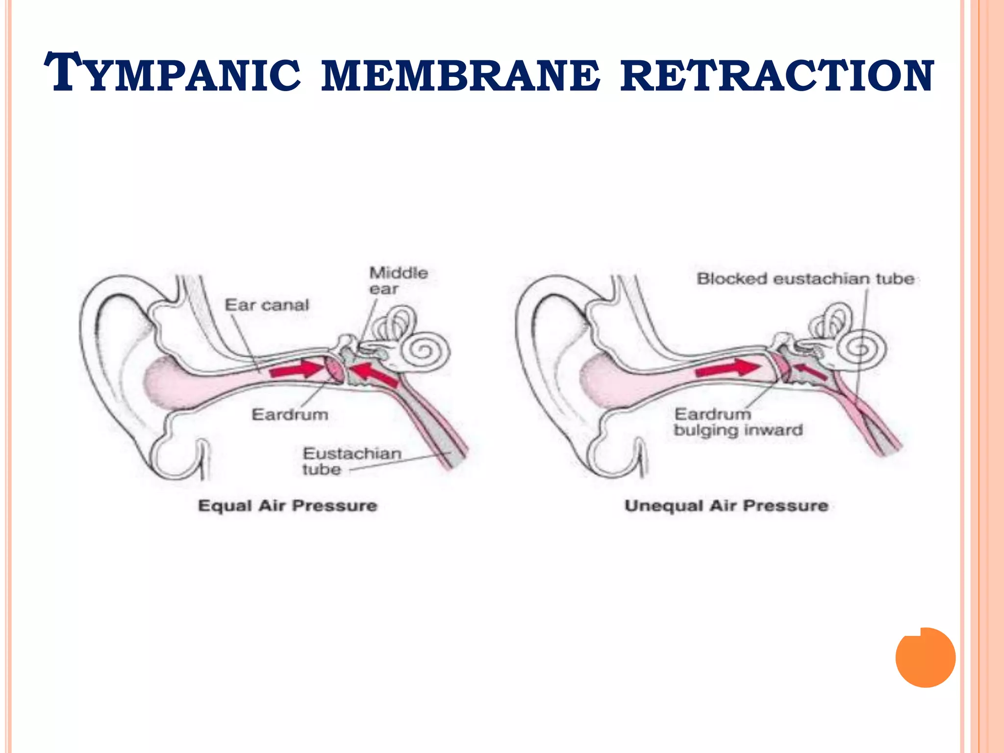 Otitis media | PDF