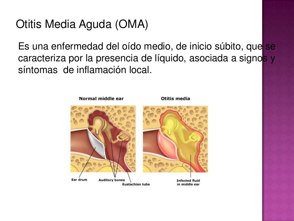 Causas De Otitis Media , Otitis Causas, síntomas y tratamiento – HRBWT