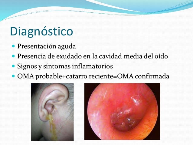 Otitis media aguda