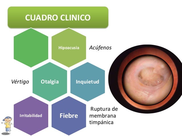 Otitis media aguda