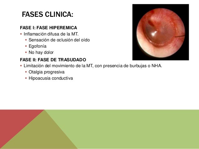 Otitis media aguda