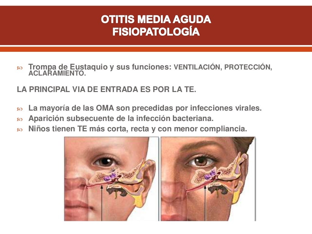 Otitis media aguda