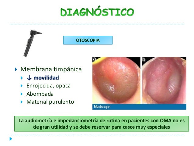 Otitis media aguda
