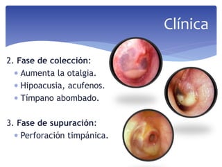Otitis media aguda | PPTX