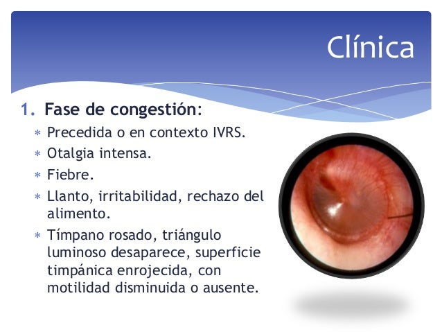 Otitis media aguda
