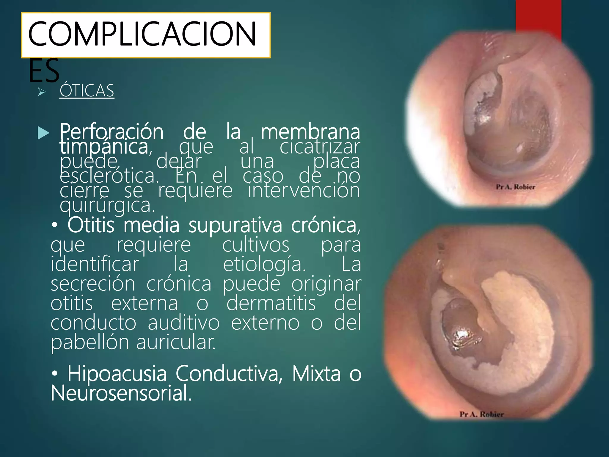 OTITIS MEDIA AGUDA-DR. OMAR GONZALES SUAZO | PPTX