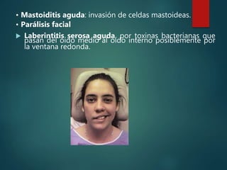 OTITIS MEDIA AGUDA-DR. OMAR GONZALES SUAZO | PPTX