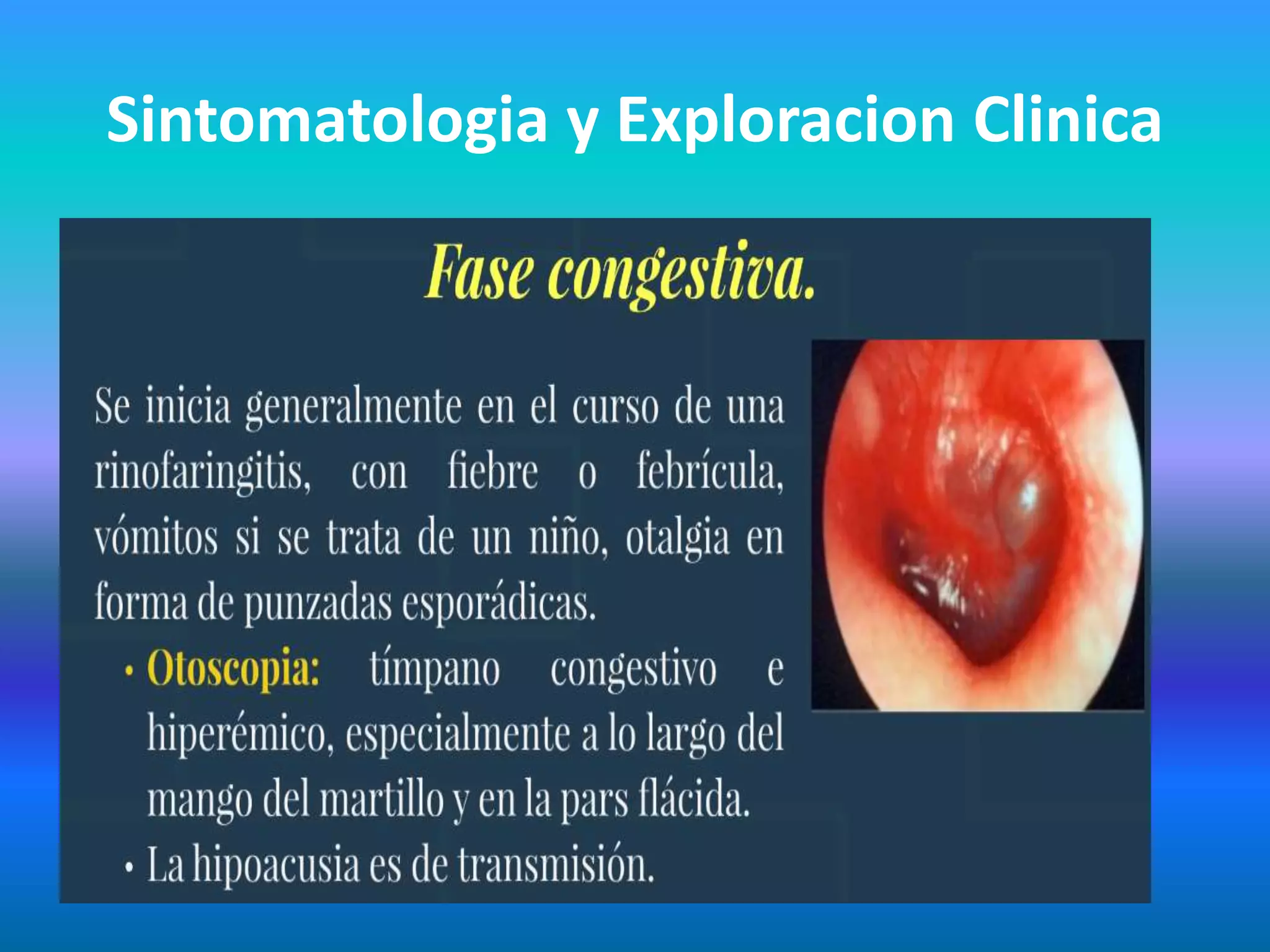 Otitis media aguda | PPTX