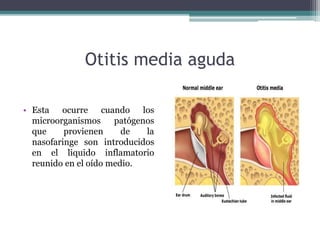 Otitis media aguda | PPT