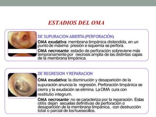 Otitis media aguda | PPTX