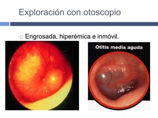 Otitis media aguda | PPTX