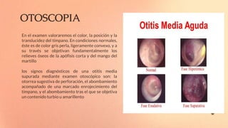Otitis media aguda.pptx