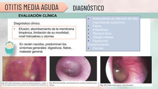 Otitis media aguda.pptx