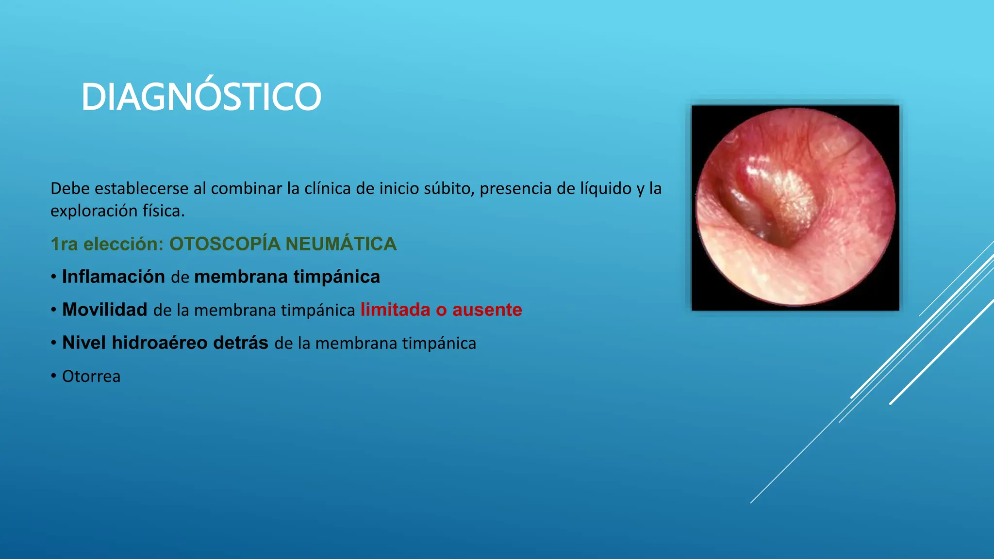OTITIS MEDIA AGUDA gpc tratamiento y diagnostico.pptx
