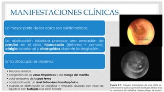 Otitis media aguda, crónica y serosa | PPTX