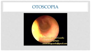 Otitis media aguda, crónica y serosa | PPTX