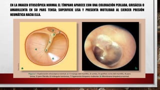 OTITIS MEDIA AGUDA diapositivas.pptx