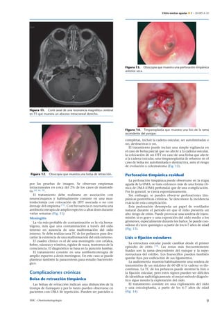 Otitis media aguda- Otorrinolaringologia | PDF