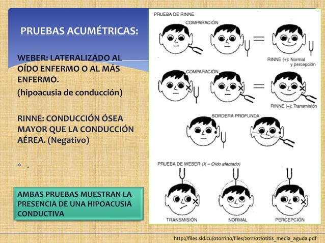 Otitis Media Aguda Viral