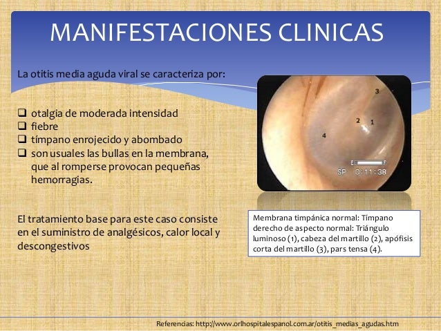 Otitis Media Aguda Viral
