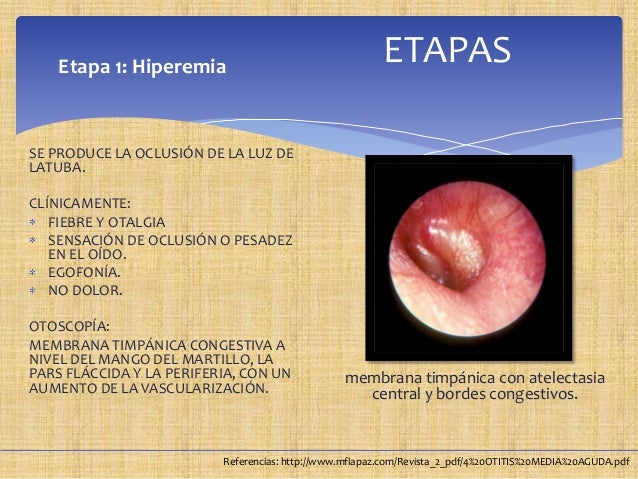 Otitis Media Aguda Viral